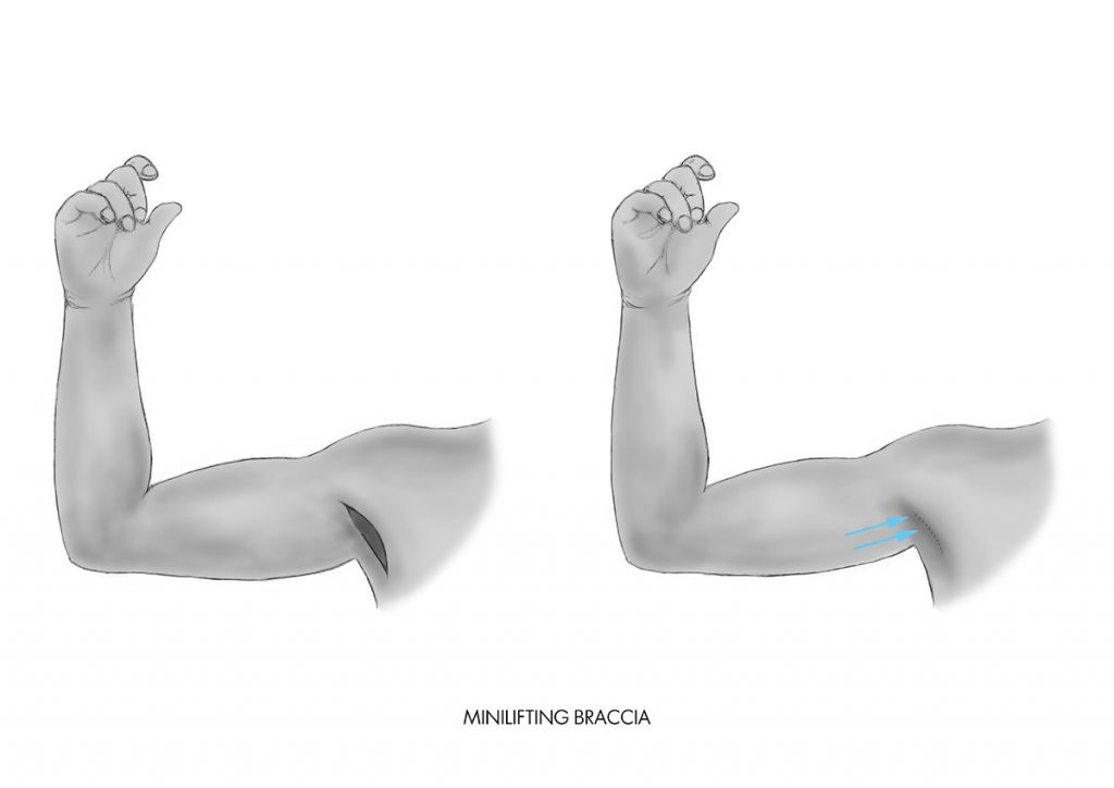 Lifting Braccia e Cosce a Pisa - Dott. Riccardo Marsili