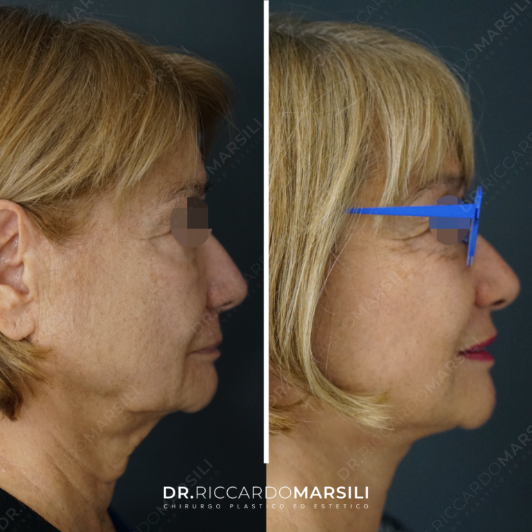 Lifting e Minilifting Viso a Pisa - Dott. Riccardo Marsili