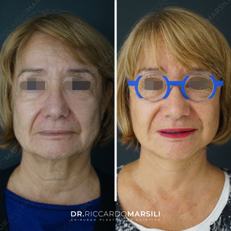 Lifting e Minilifting Viso a Pisa - Dott. Riccardo Marsili